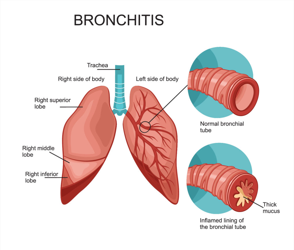 Akute Bronchitis Lungenfach rztliche Gruppenpraxis Akute Bronchitis Lungenfach rztliche Gruppenpraxis